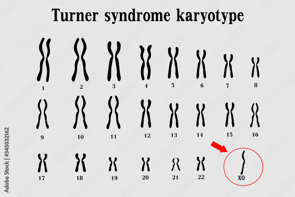 Vetor de Karyotype of Turner syndrome (TS), also known 45,X, or 45,X0 ...