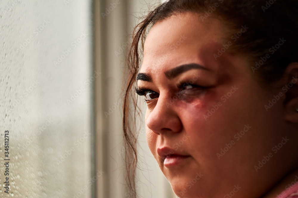 Woman with bruise on face sadly looking, bruised face close-up Stock ...