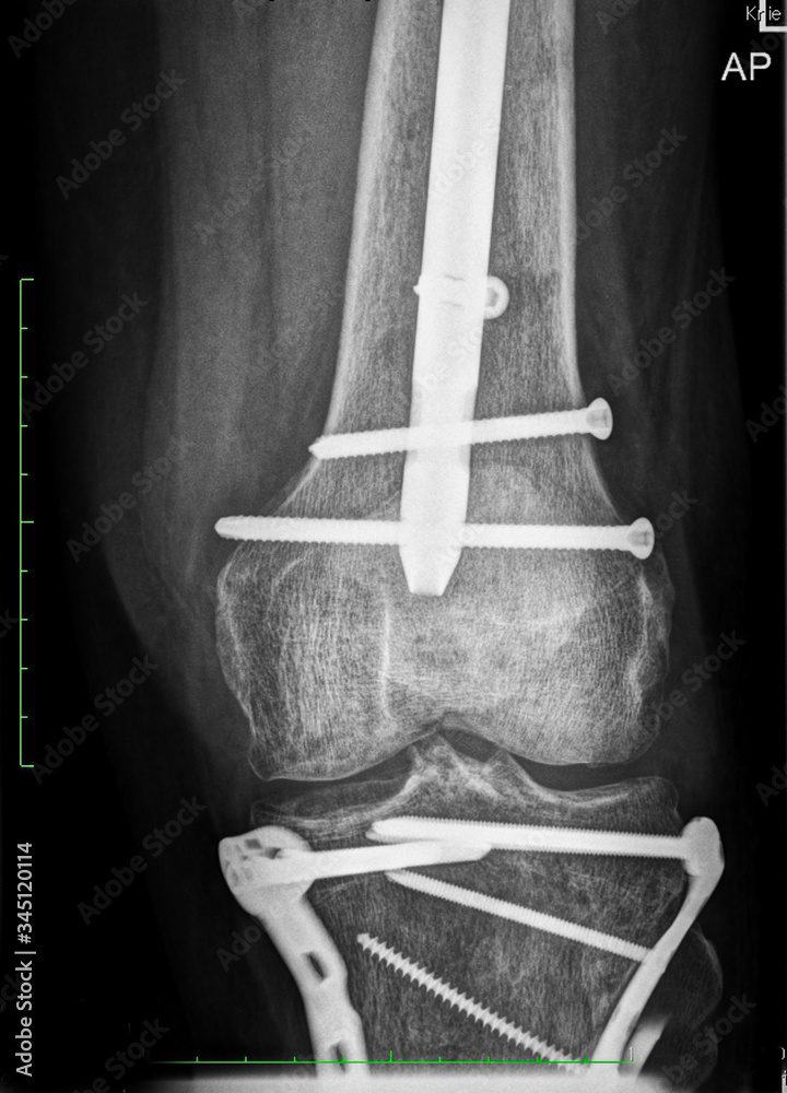 Radiographs, x-rays of a heavily injured motorcyclist with multiple ...