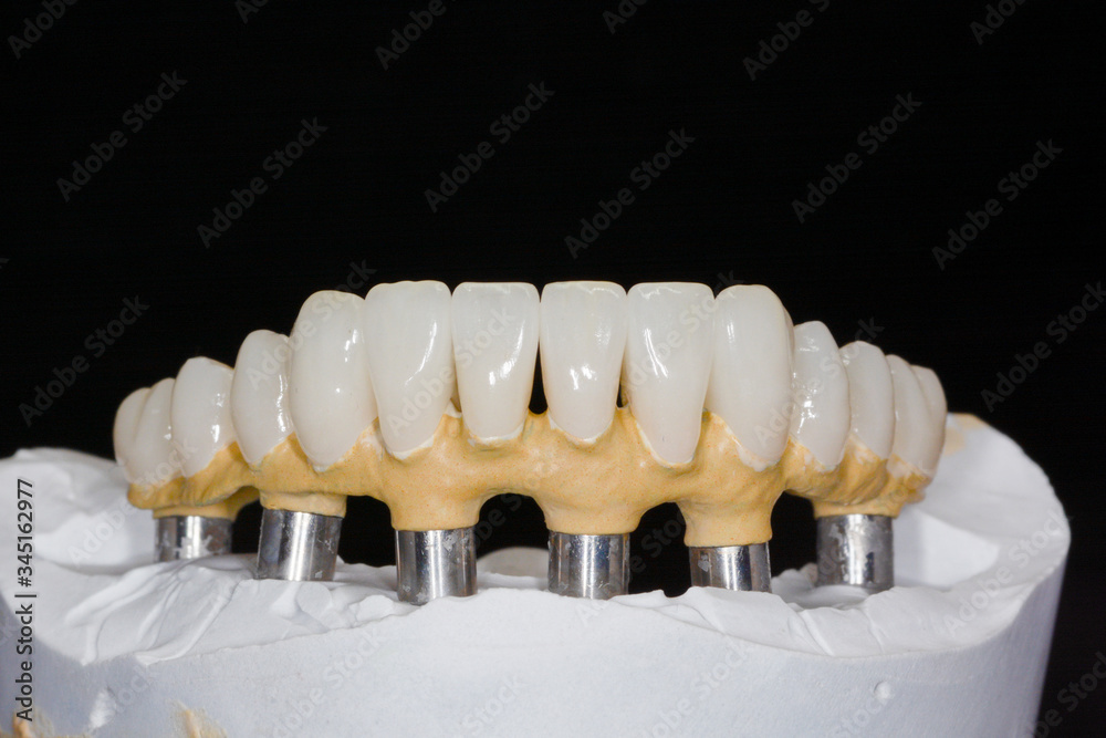 Dental prosthetics on implants, artificial jaw with dentures on the ...