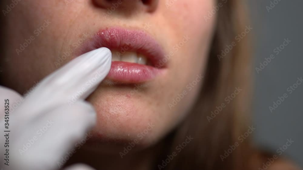 Weak immune system causing viral herpes appearing on human lips. Young ...