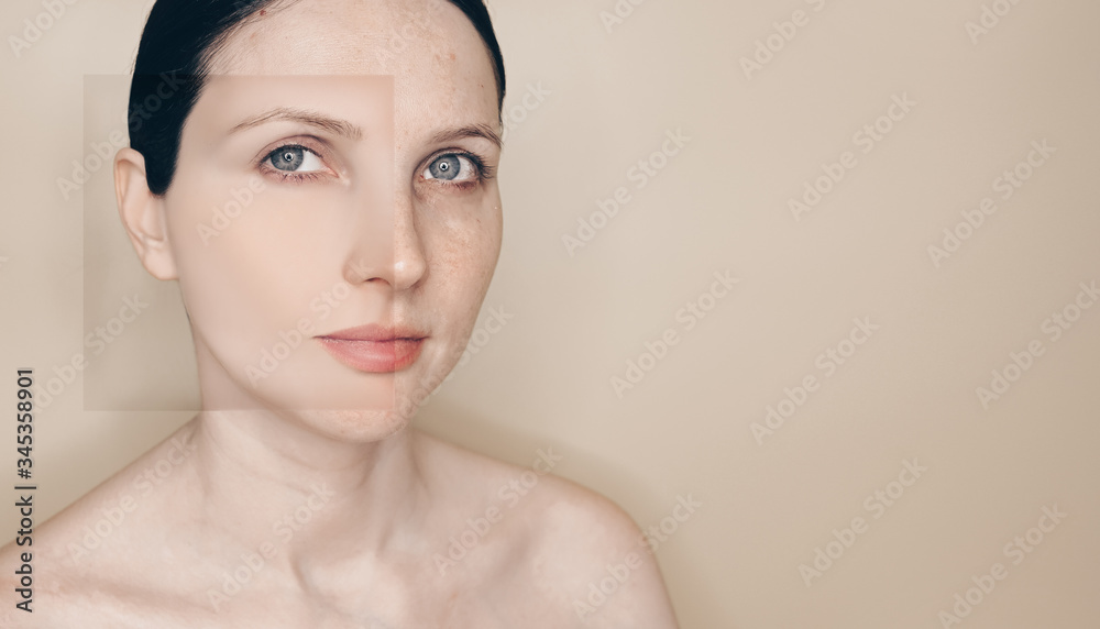 Beautiful woman with a problem vascular skin. Photo before and after ...