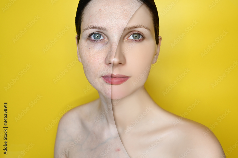 Beautiful woman with a problem vascular skin. Photo before and after ...