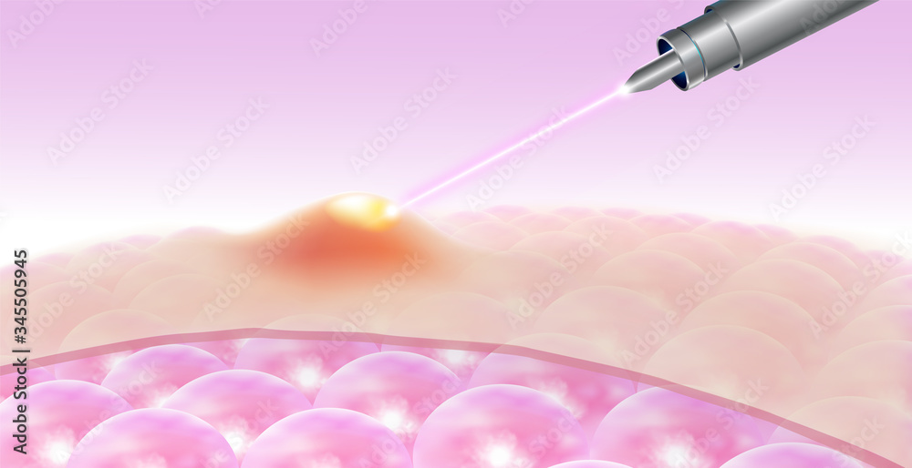 Laser skin treatment blemish acne scars on the epidermis does not ...