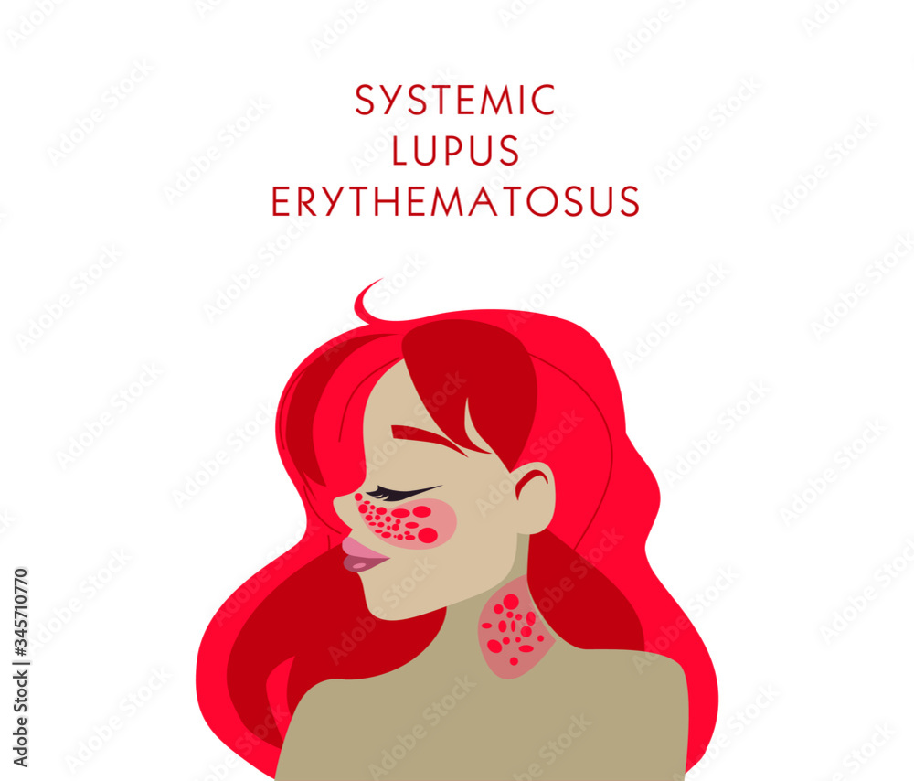 Poster SLE, red systemic lupus erythematosus, red butterfly on the face ...