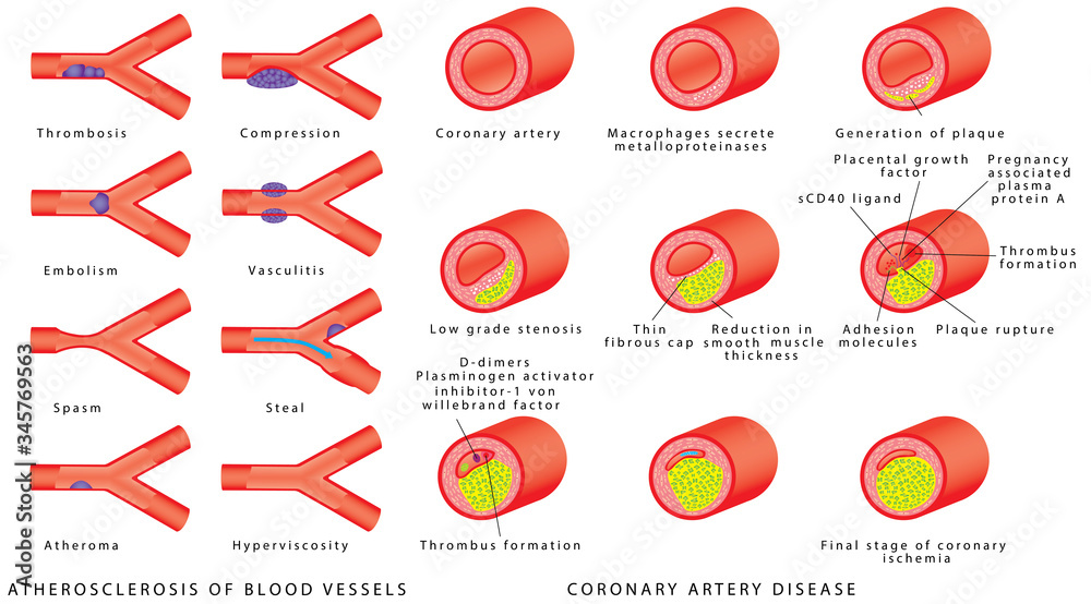 Blood vessels - arteries. Atherosclerosis of blood vessels. Healthy and ... Blood vessels - arteries. Atherosclerosis of blood vessels. Healthy and ...