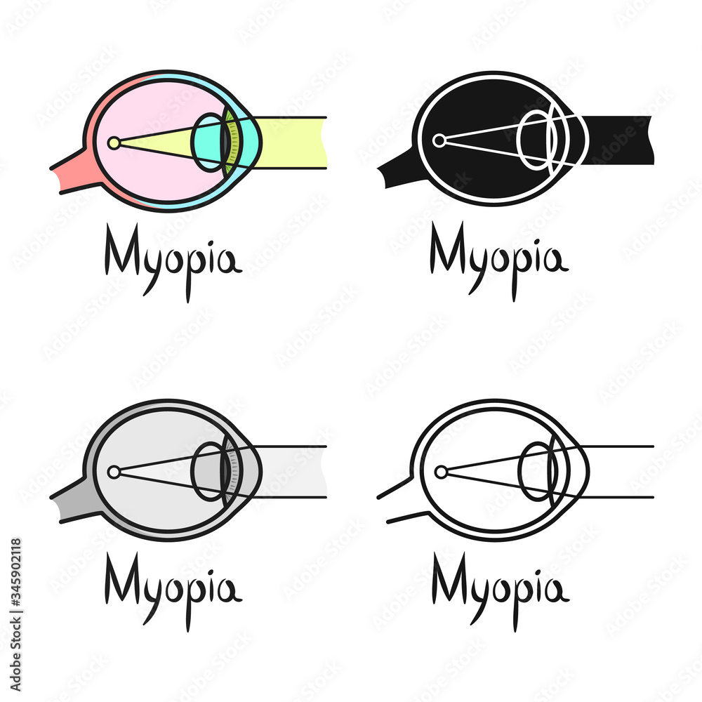 Vector illustration of myopia and eye symbol. Web element of myopia and ...