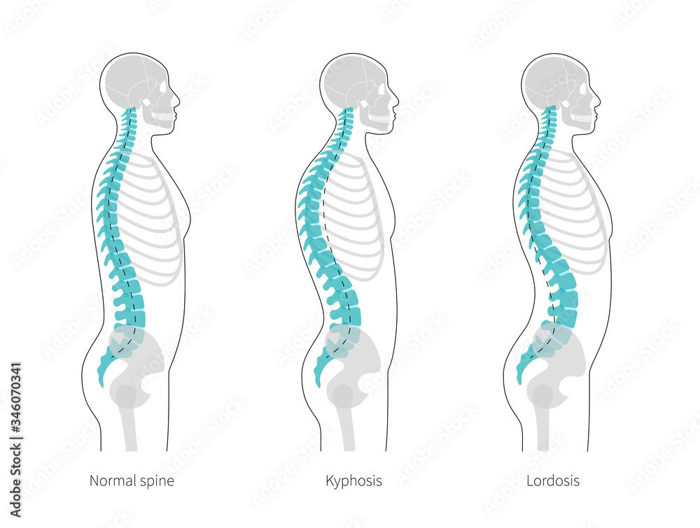 Kyphosis, lordosis flat vector illustration. Stock Vector | Adobe Stock