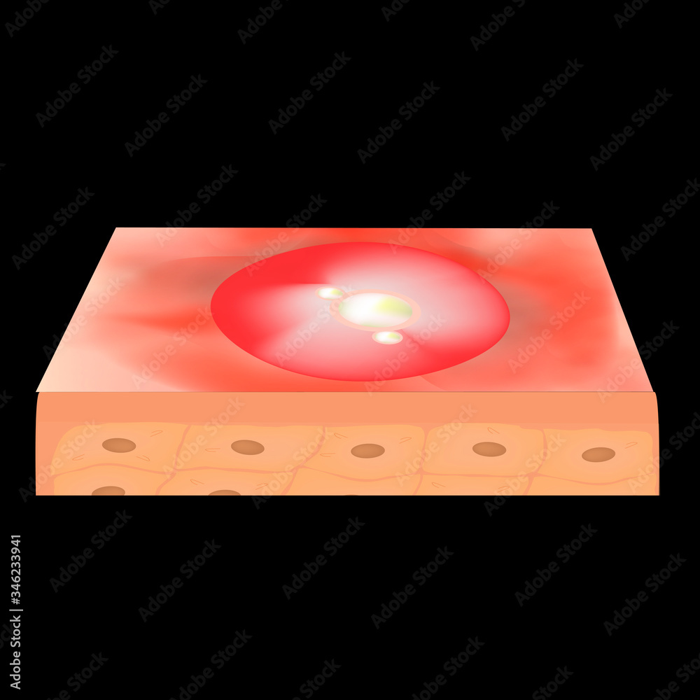 Cyst acne. furuncle Acne on the skin cysts and pimples. Dermatological ...