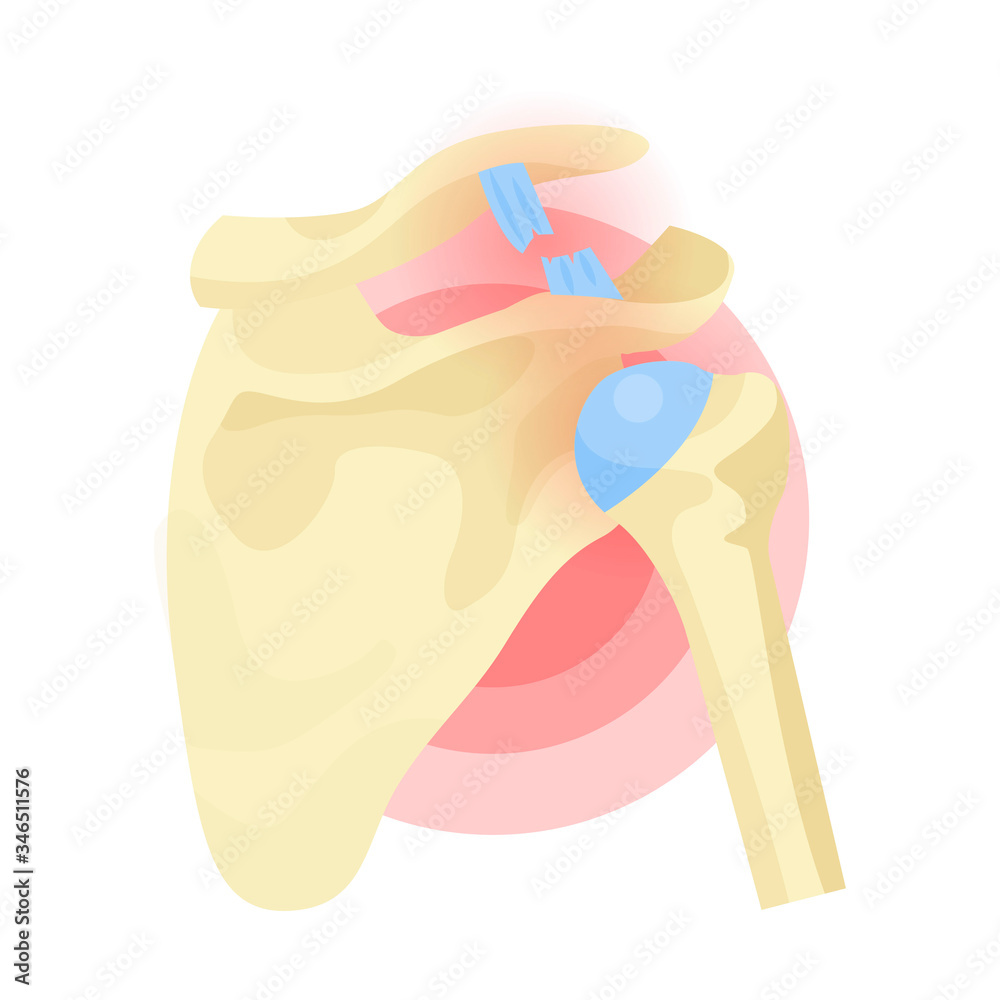 Shoulder dislocation, rupture of tendon, ligament, joints ...