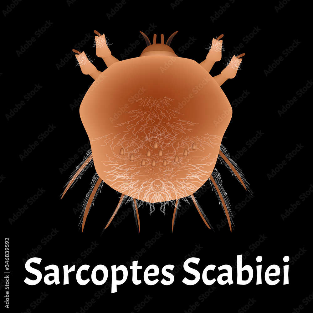 Sarcoptes scabiei. scabies. Sexually transmitted disease. Infographics ...