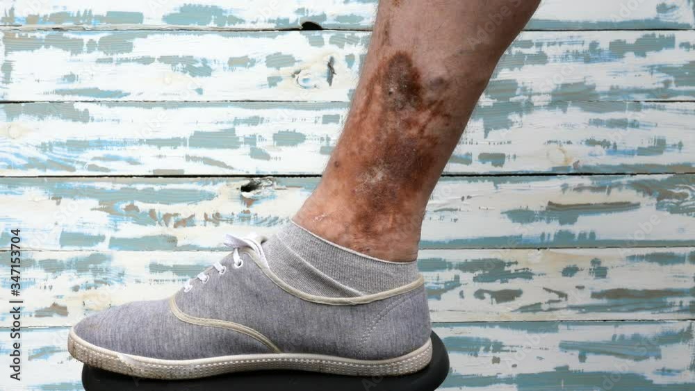 Bad leg and Illness of human skin. Scratch scars, ulcers and age spots ...