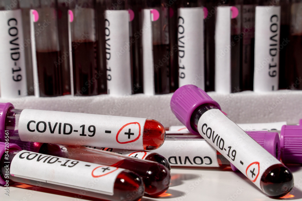Test tubes with blood positive for COVID-19 virus are on the doctor’s ...