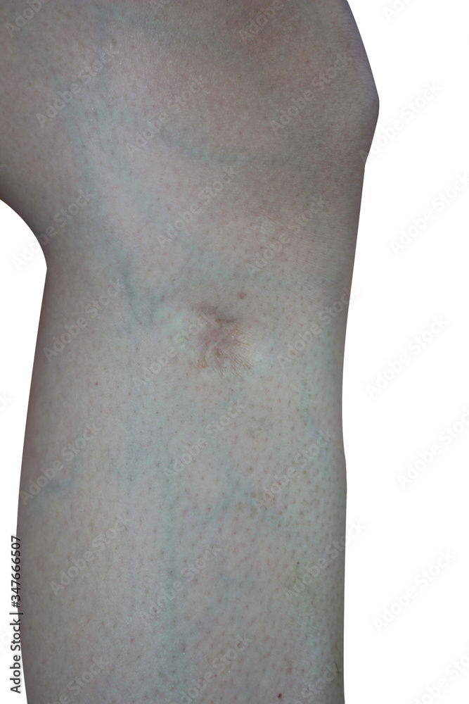 Scars on the skin around the legs, Scar on a girl's leg close-up ...