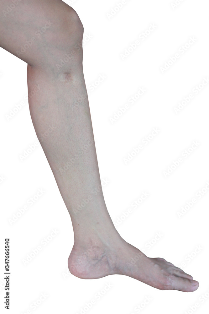 Scars on the skin around the legs, Scar on a girl's leg close-up ...