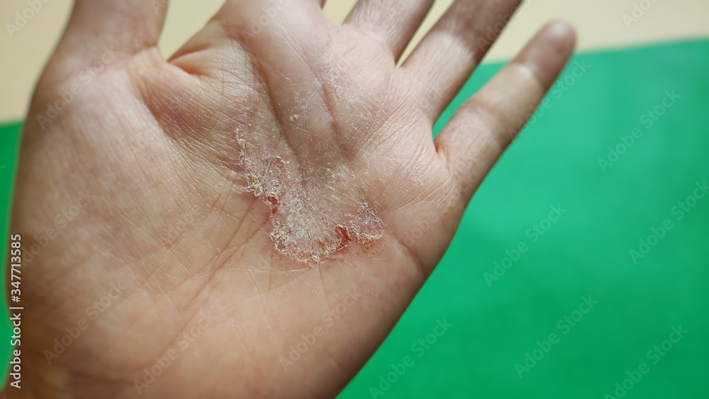 Healthcare concept - worsen skin rash on palm Stock Photo | Adobe Stock