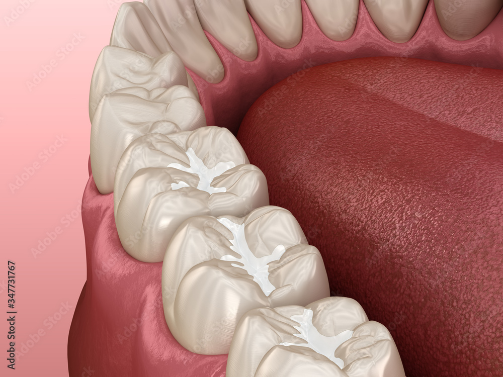 Molar Fissure dental fillings, Medically accurate 3D illustration of ...