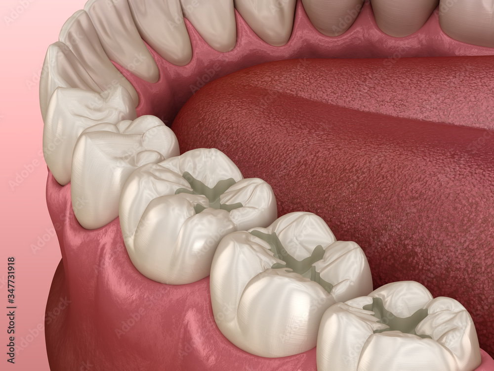 Prepareted Molar Fissure for fillings placement, Medically accurate 3D ...