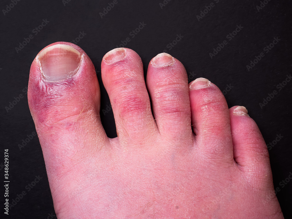 A man's toes showing what looks like a rash with red blotchy skin. A ...