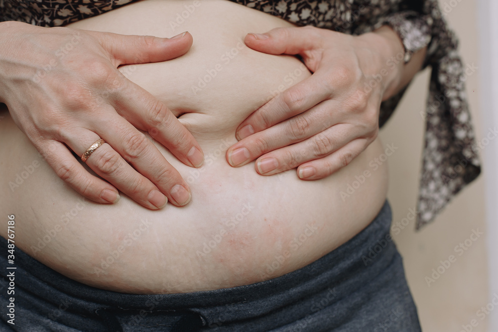 fat women has overweight. she used hands squeezing excess fat of the ...