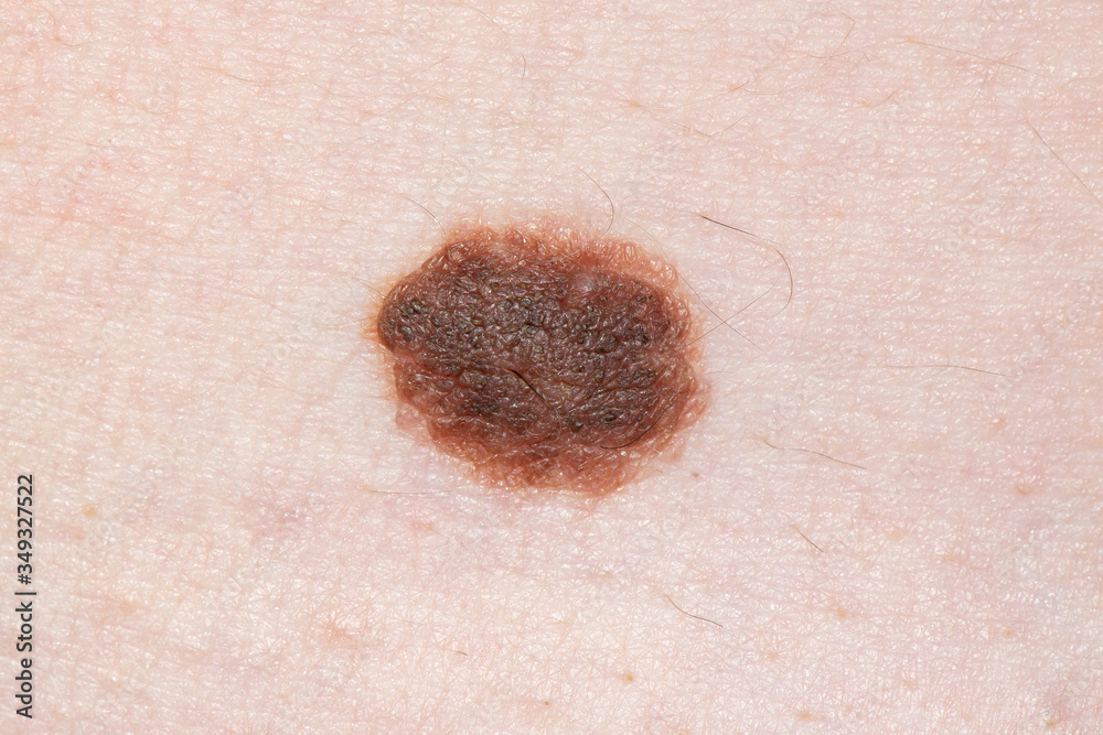 Big brown mole on human skin. Dermatology prevention moles female skin ...