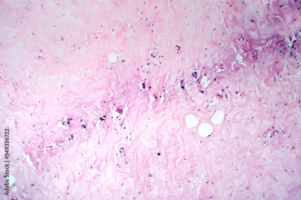 Breast fibroadenosis, light micrograph Stock Photo | Adobe Stock