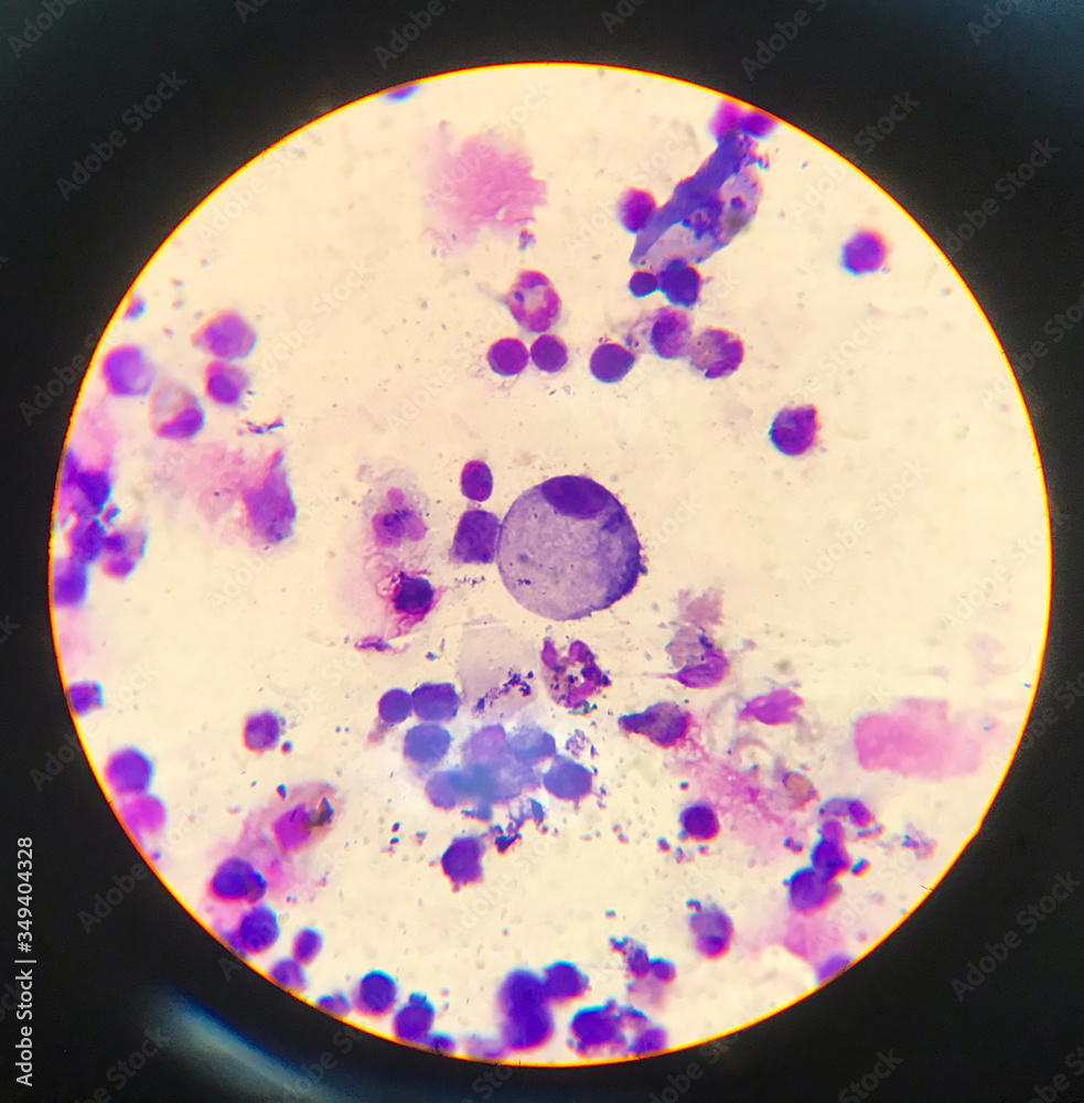 Atypical cells in body fluid smear. Stock Photo | Adobe Stock