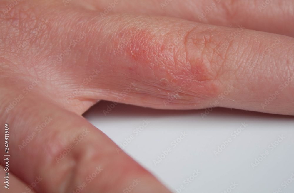 Mano de paciente con dermatitis atópica interdigital en la consulta de ...