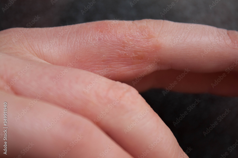 Mano de paciente con dermatitis atópica interdigital en la consulta de ...
