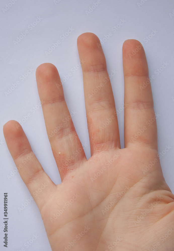 Mano de paciente con dermatitis atópica interdigital en la consulta de ...