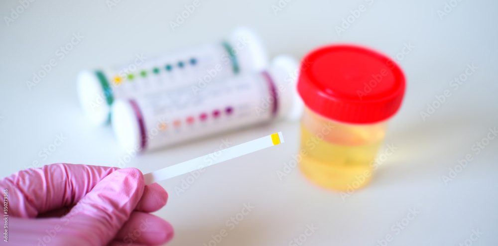 Urine sample in container. Medical exam, Urine test strip looking for ...