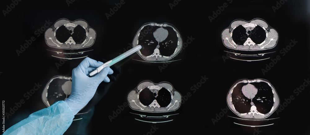 Coronavirus covid19, computed tomography of the lungs with pneumonia ...