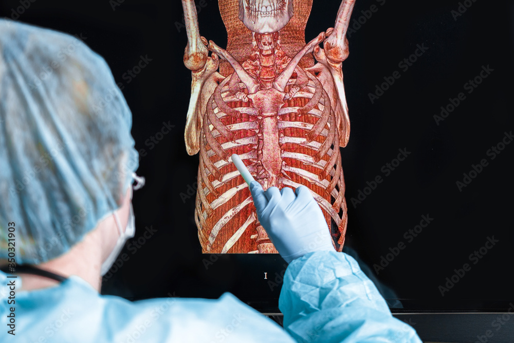Coronavirus covid19, computed tomography of the lungs with pneumonia ...