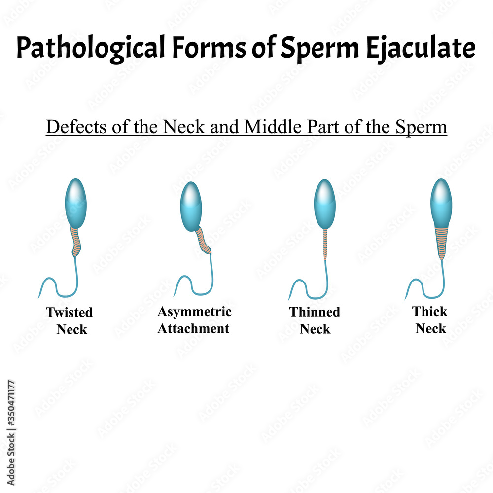 Pathological forms of sperm in the ejaculate. Male infertility ...