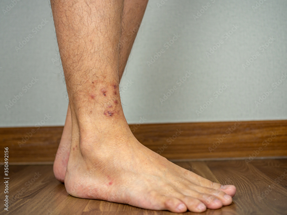 Dermatitis on feet ankle condition Stock Photo | Adobe Stock