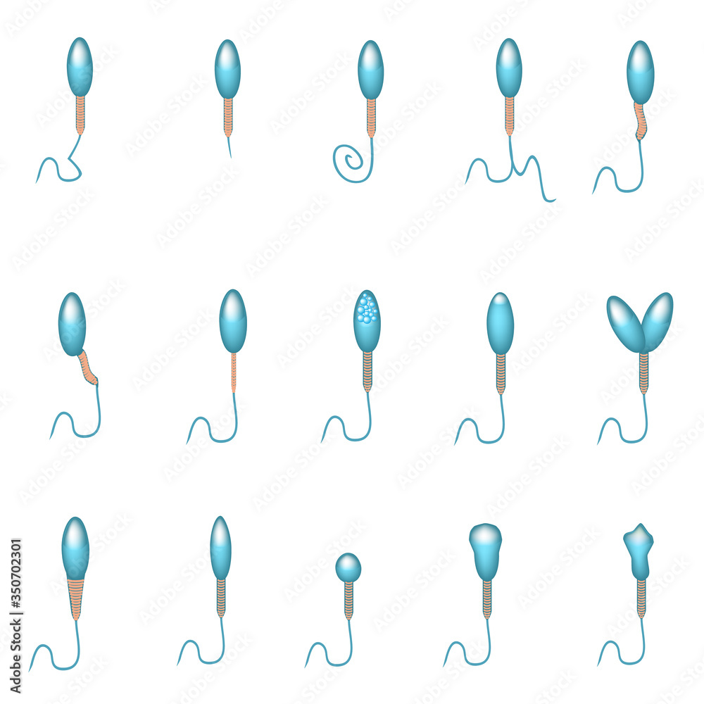 Pathological forms of sperm in the ejaculate. Male infertility ...