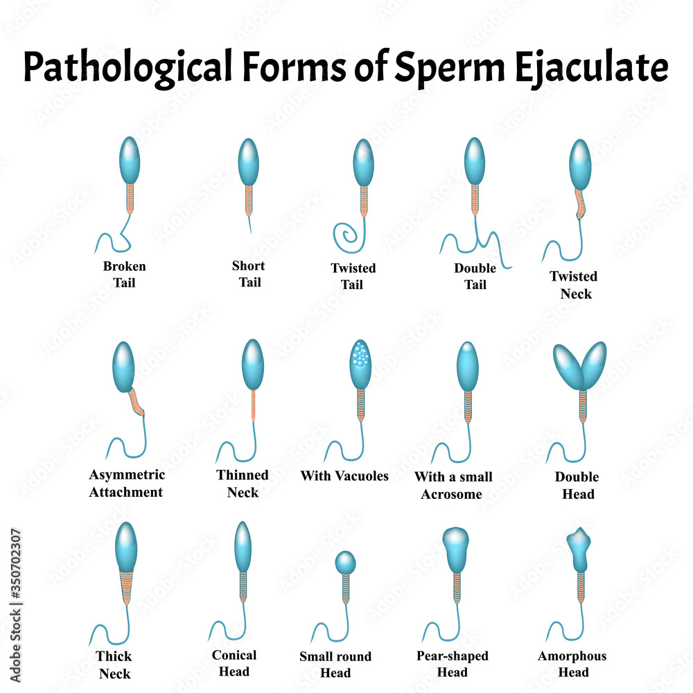 Pathological forms of sperm in the ejaculate. Male infertility ...
