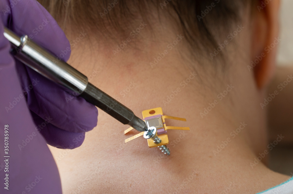 implantation of chip under the human skin. microchip is connected to ...