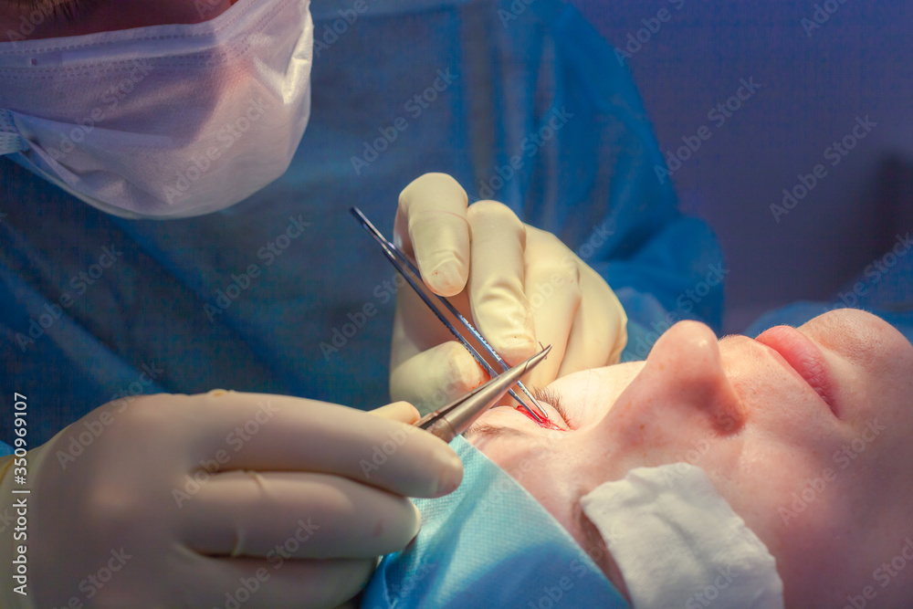 Close up of the face of a patient who is undergoing blepharoplasty. The ...