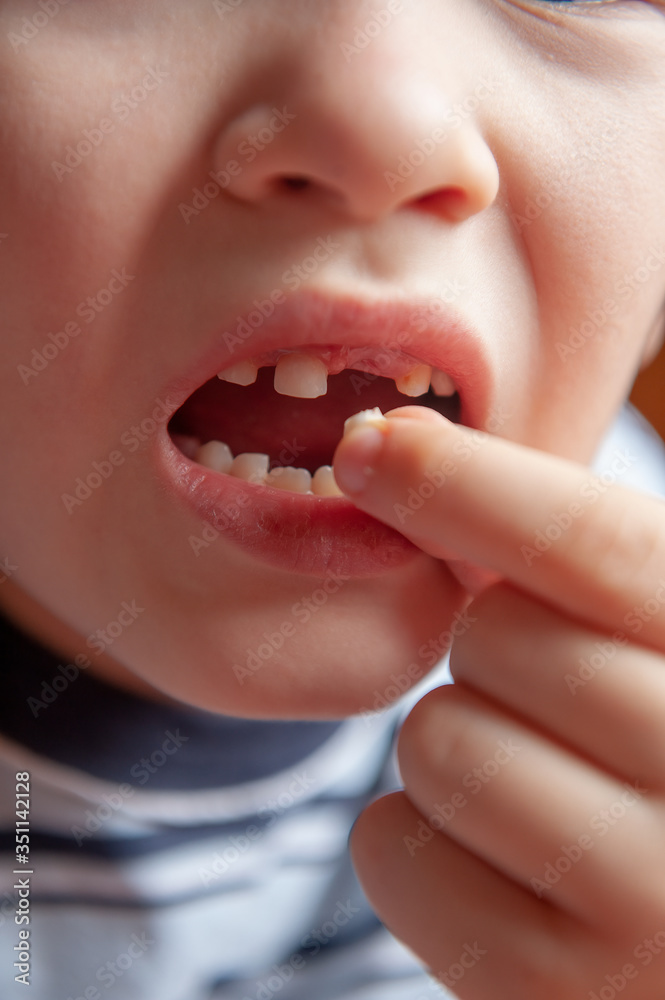 Cute baby shows dropped baby tooth. Boy smiles with toothless mouth ...