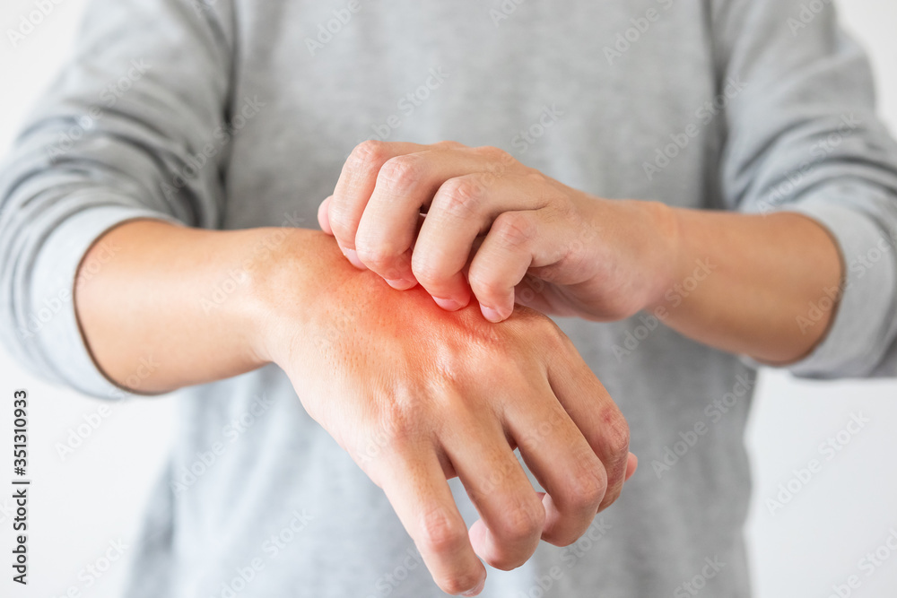 Young asian man itching and scratching on hand from itchy dry skin ...