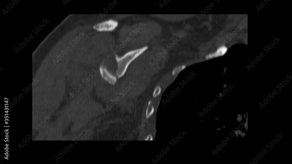 CT Scan shoulder. Fracture posterior half of glenoid with posterior ...