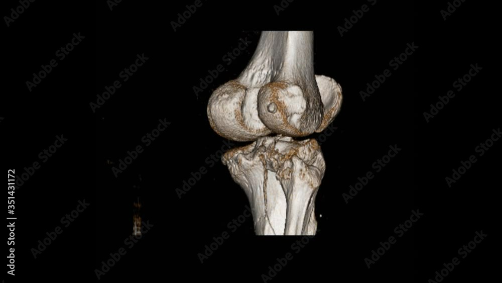 CT Scan knee of the patient periarticular injuries fracture of the ...