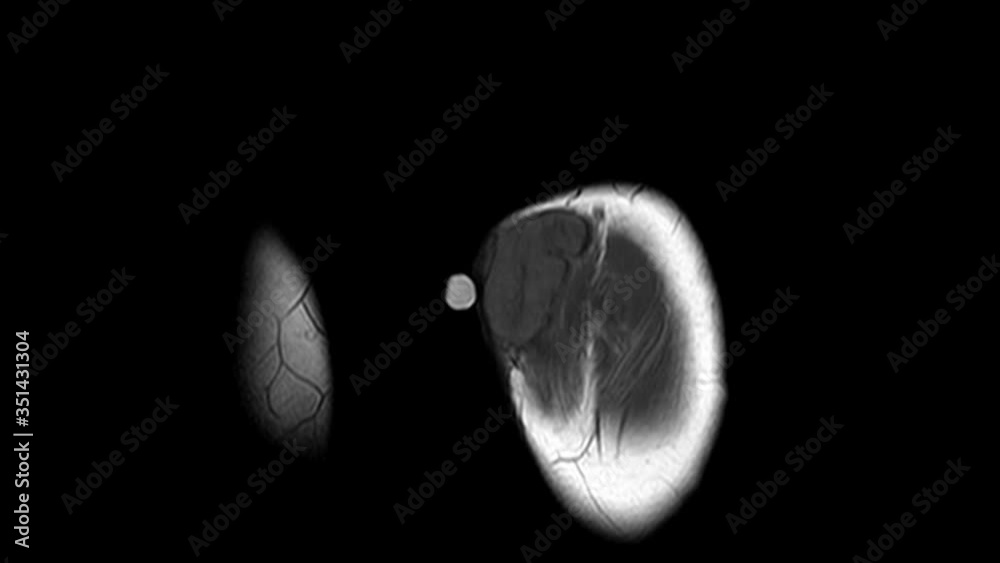MRI (Magnetic resonance imaging) of Leg.A large, well-circumscribed ...