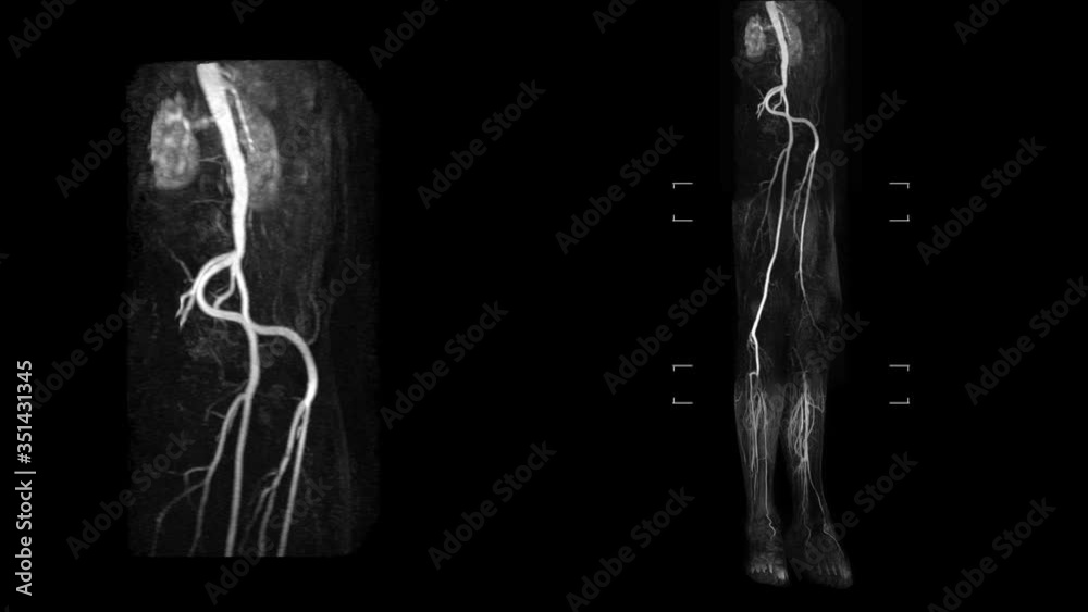 Magnetic Resonance Angiography, MRA of lower extremity , MRA femoral ...