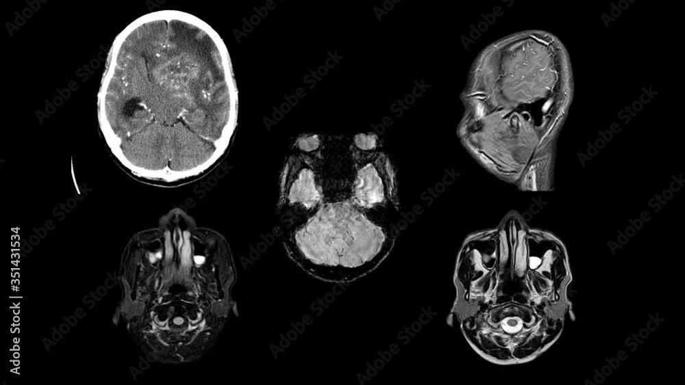 MRI OF BRAIN Impression: A 5cm isodensity mass with ill defined margin ...