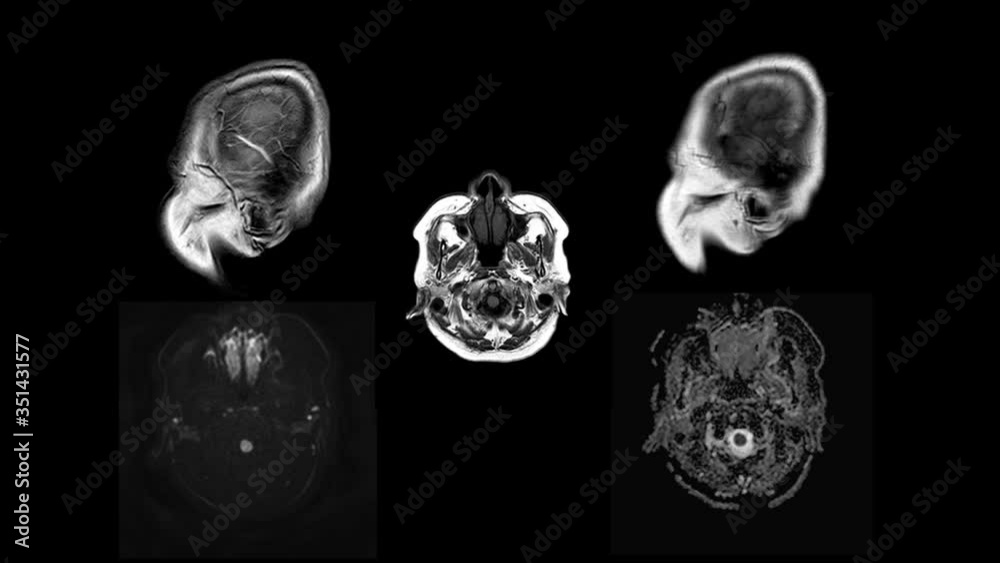 MRI OF BRAIN Impression: A 5cm isodensity mass with ill defined margin ...