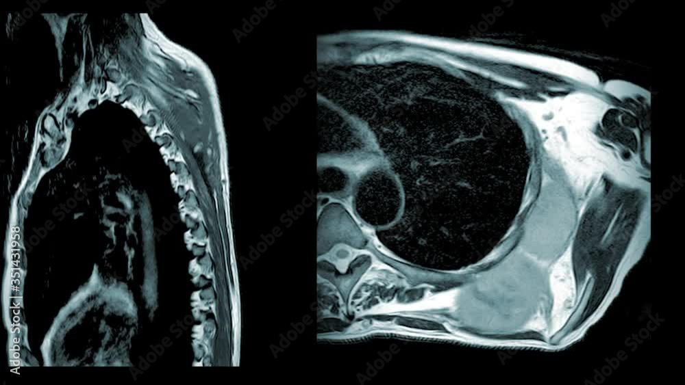 Magnetic resonance (MRI) of Shoulder Joint Impression:The mass Lt ...
