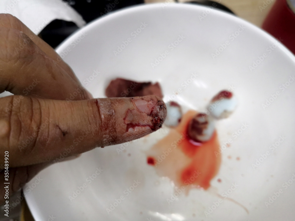 Finger wound,Physical injury blood wound human hand finger nail.Injured ...