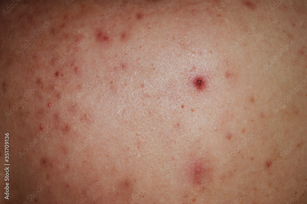 Problem skin with acne, with red spots, black dots on the back ...